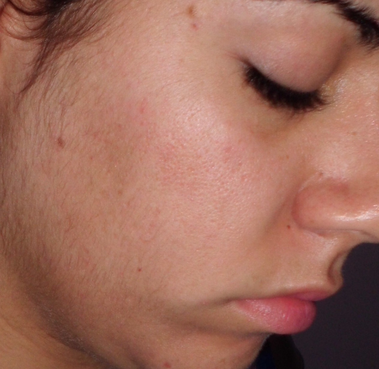 PAPULEX Dile adiós al Acné