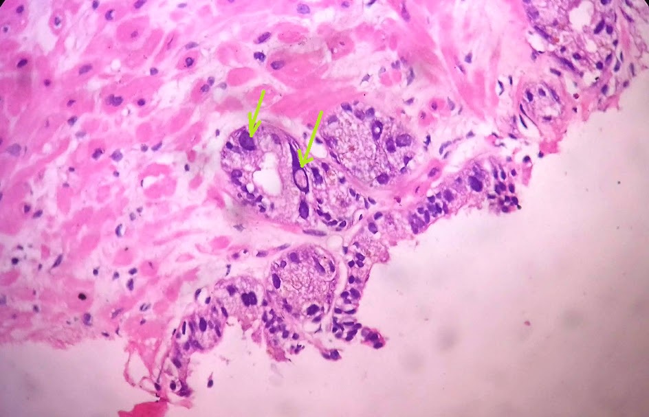 KIMAN - Making pathology simple!!: "Are You Afraid Of Monster Cells ...