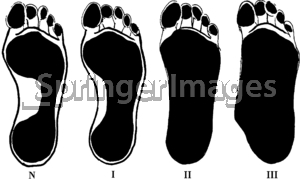 Fisioterapia em Traumato-Ortopedia Baseada em Evidências: Pé plano ...