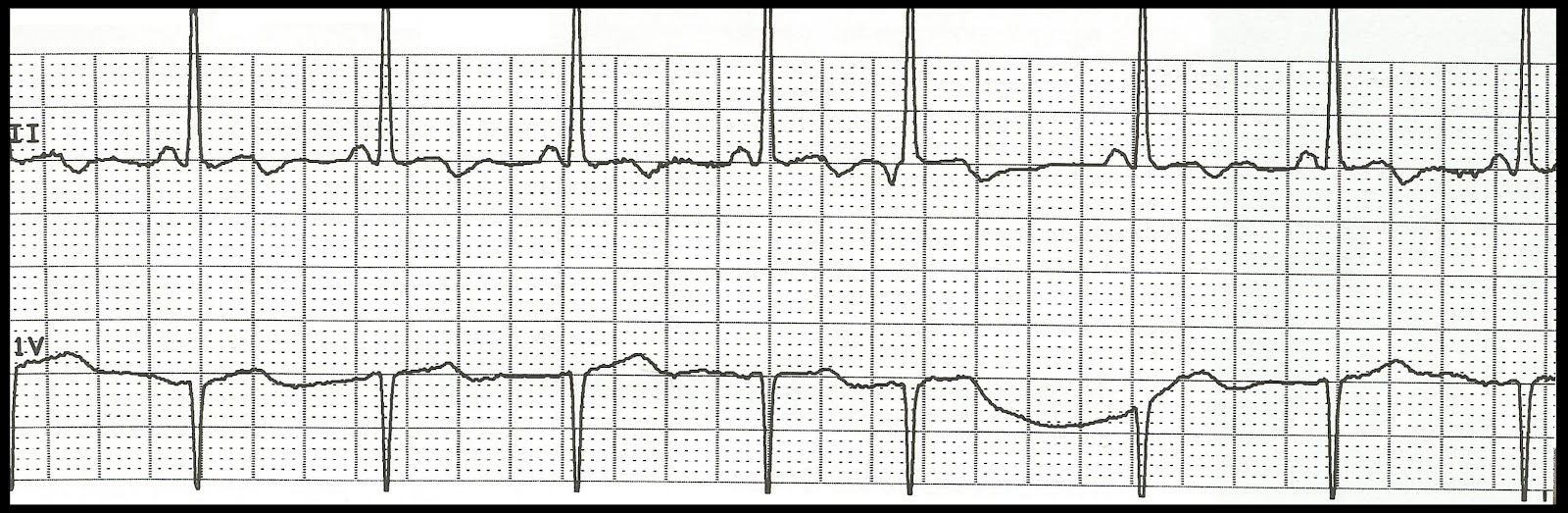 Basic ECG Rhythm Test 05