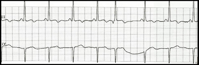 Basic ECG Rhythm Test 05