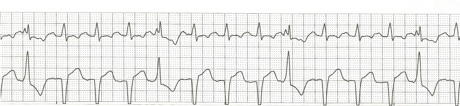 EKG Rhythm Strips 81: Bigeminy, Trigeminy, Quadrigeminy...