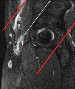 MRI Protocols: Pubic Bone MRI Protocol