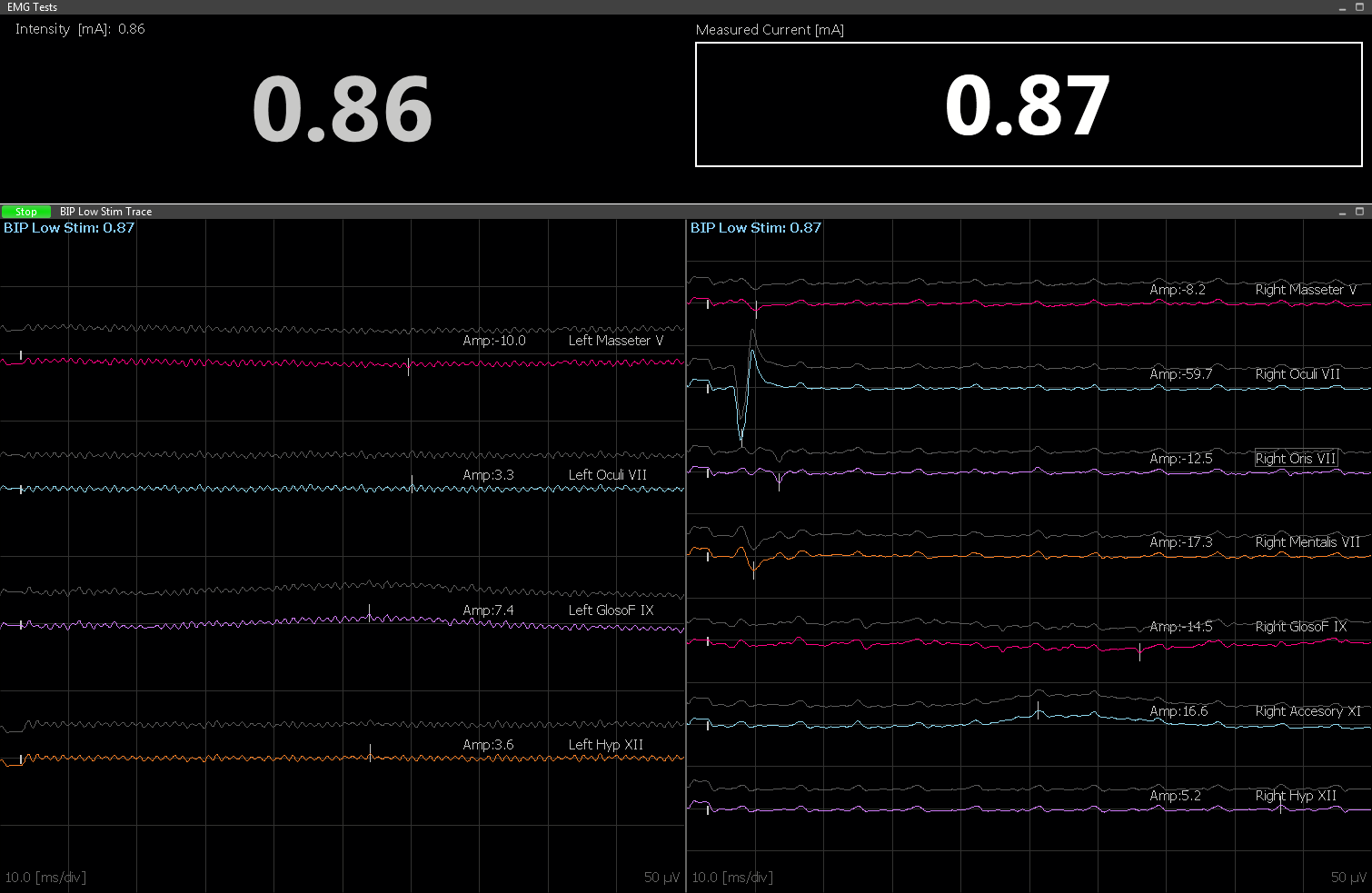 Neurophysiology Plus Iceland: Cerebellopontine angle (CPA) mass IONM