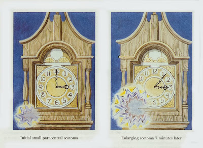 Pharmaceutical Advertisement Collection: Migraine with aura (Visual Aura)