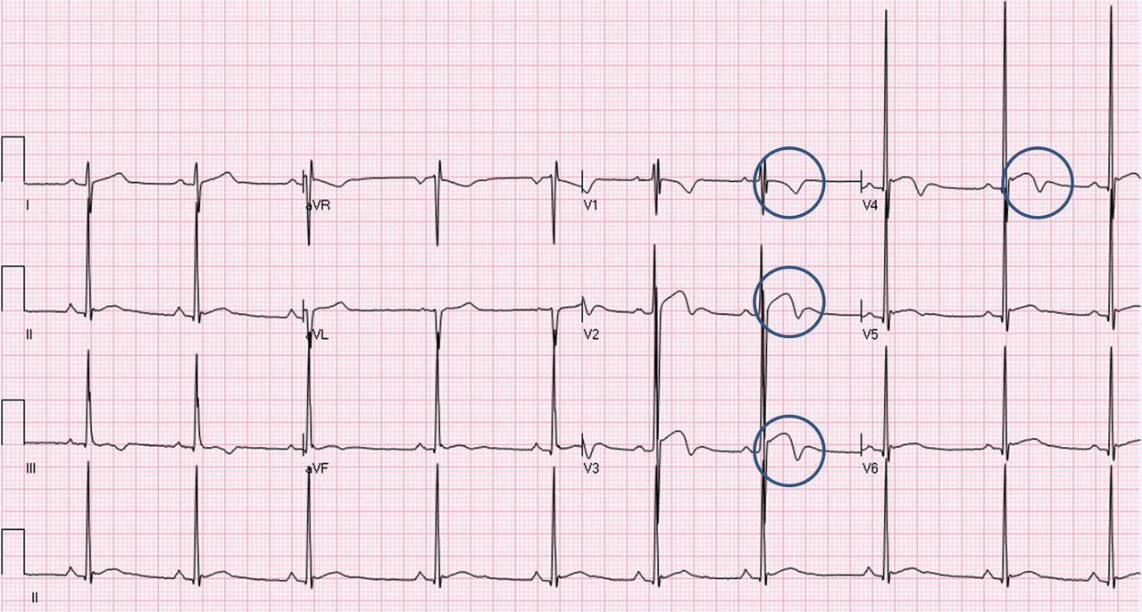 Dr. Smith's ECG Blog: 15 yo AAM with ST Elevation and T-wave Inversion ...