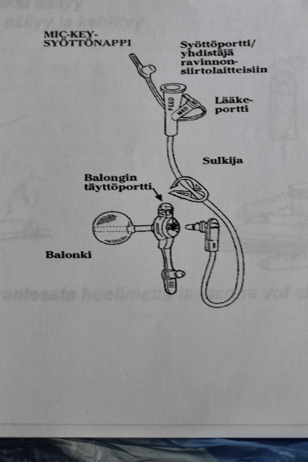 Aaronin tarina: PEG-nappi
