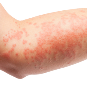 Skin Rashes and ARV's ~ Living with HIV in the Philippines