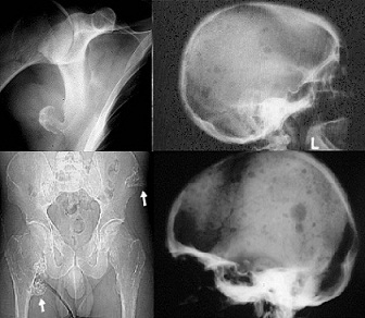 Dr Herry Setya Yudha Utama SpB. FInaCS. MHKes. ICS: Malignant Bone ...