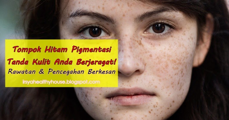Tompok Hitam di Muka Tanda Jeragat! Ketahui Punca dan Cara Rawatan ...