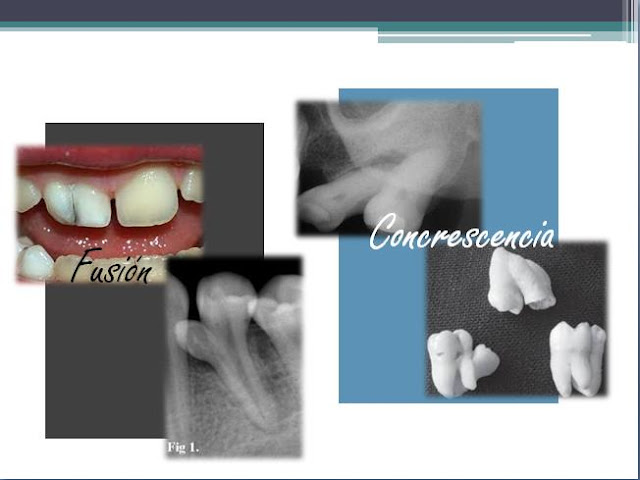 DENTAL 1001 UNAM: Macro y Microdoncia, y otras Anomalías Dentales ...