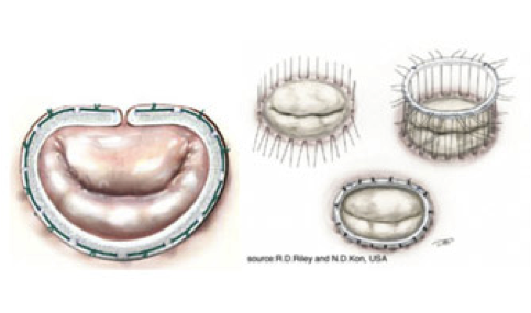 Cirugías posibles para la valvulopatía mitral ~ El blog de la válvula ...