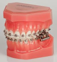 Bovenizer Orthodontics Blog: Why Use AdvanSync Over a Traditional Herbst?