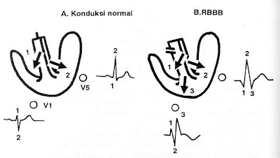 Right Bundle Branch Block / RBBB (Blok Cabang Berkas Kanan/BCBKa ...