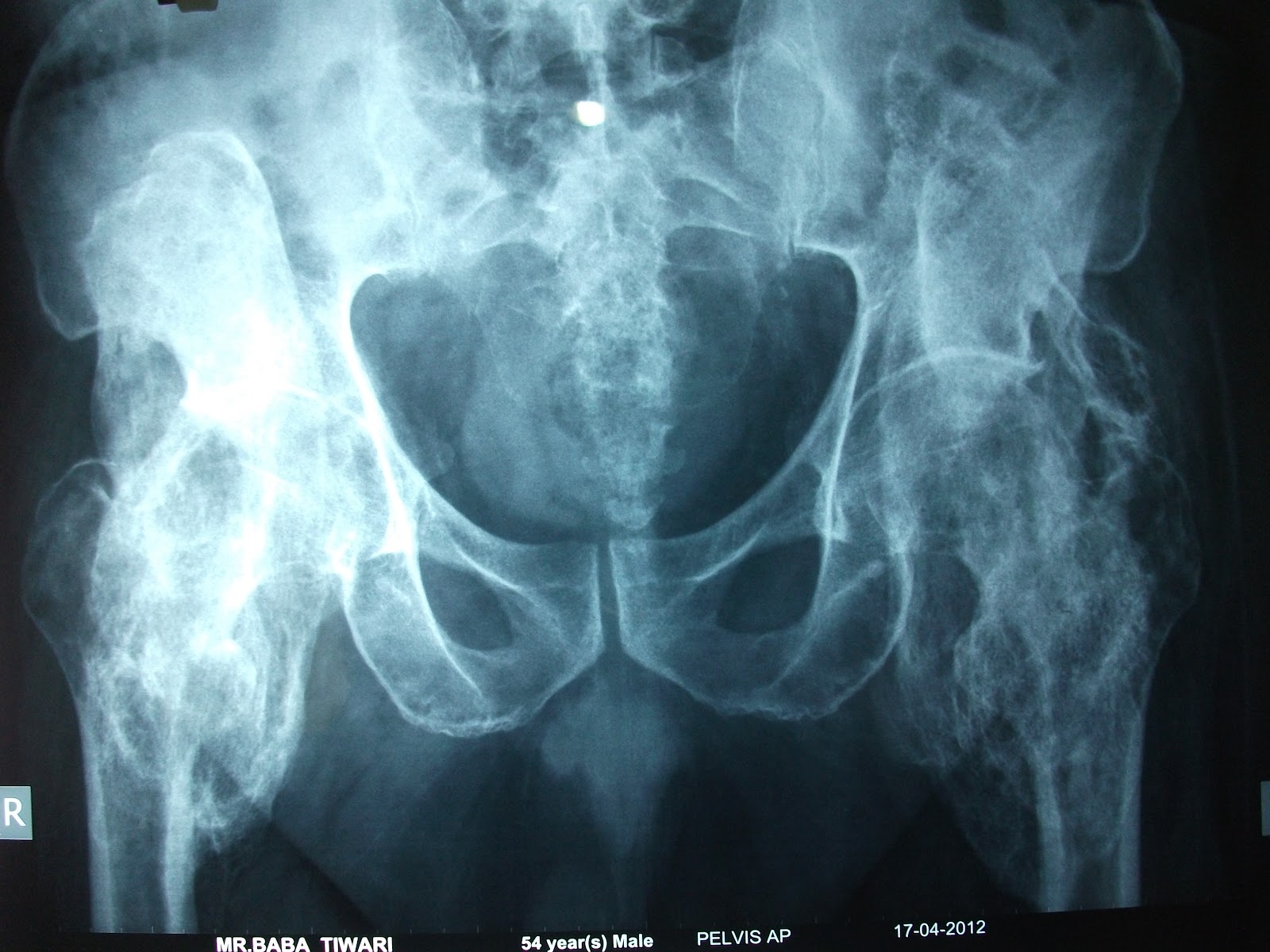 Joint Preservation and Replacement : Bilateral hip ankylosis with HO