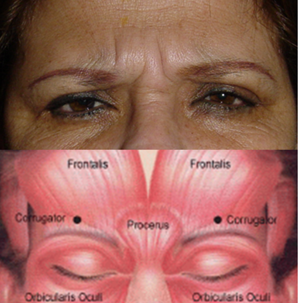 ¿BORRAR UN CEÑO FRUNCIDO?