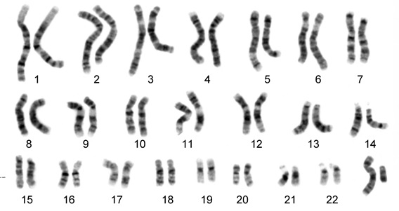 BIOLOGI GONZAGA: ABNORMALLY - NON DISJUNCTION AND MUTASI KROMOSOM