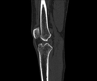 CT Knee - Radiology Imaging