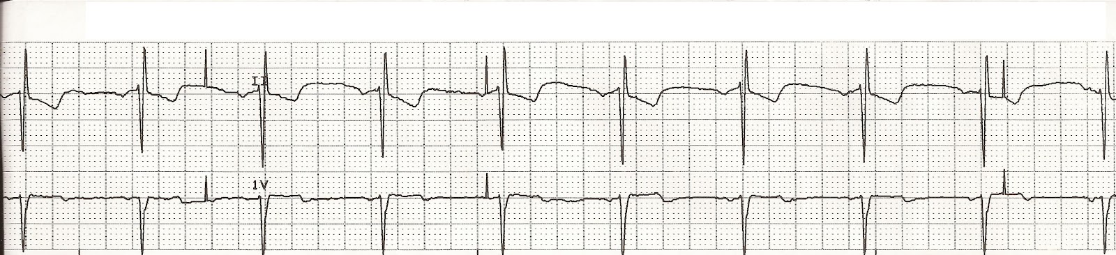 EKG Rhythm Strip Quiz 56: Paced Rhythms