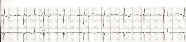EKG Rhythm Strip Quiz 56: Paced Rhythms