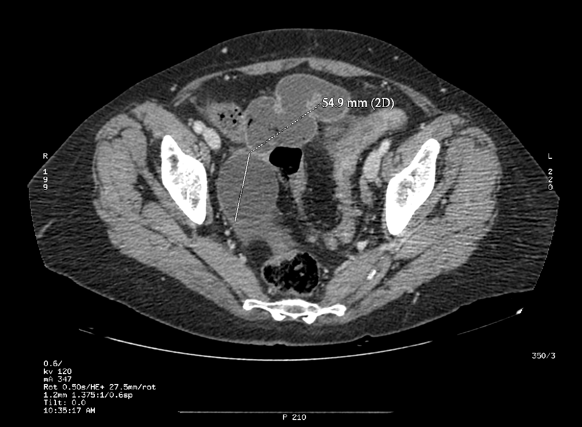 El Blog de Isa y Juan: Obstrucción intestinal por bridas
