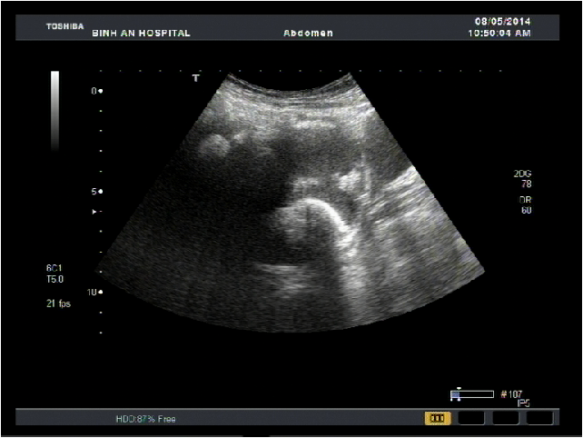 VIETNAMESE MEDIC ULTRASOUND: CASE 253: GOSSYPIBOMA (TEXTILOMA) POST ...