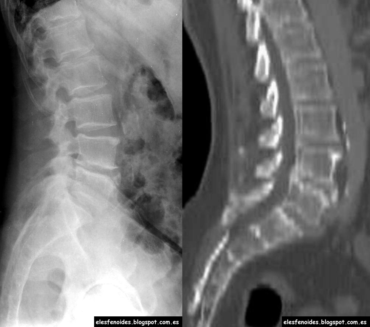 El esfenoides: Vértebra en limbo lumbar. 2 imágenes 1 caso.