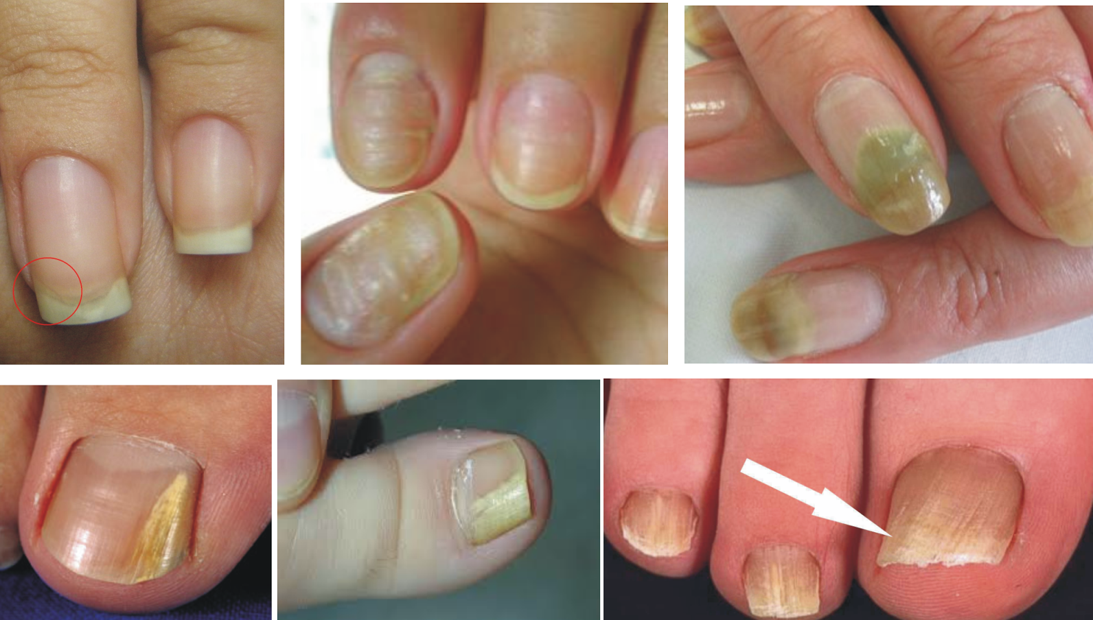 5 Receitas para acabar com a Micose nas Unhas - Como evitar, se ...