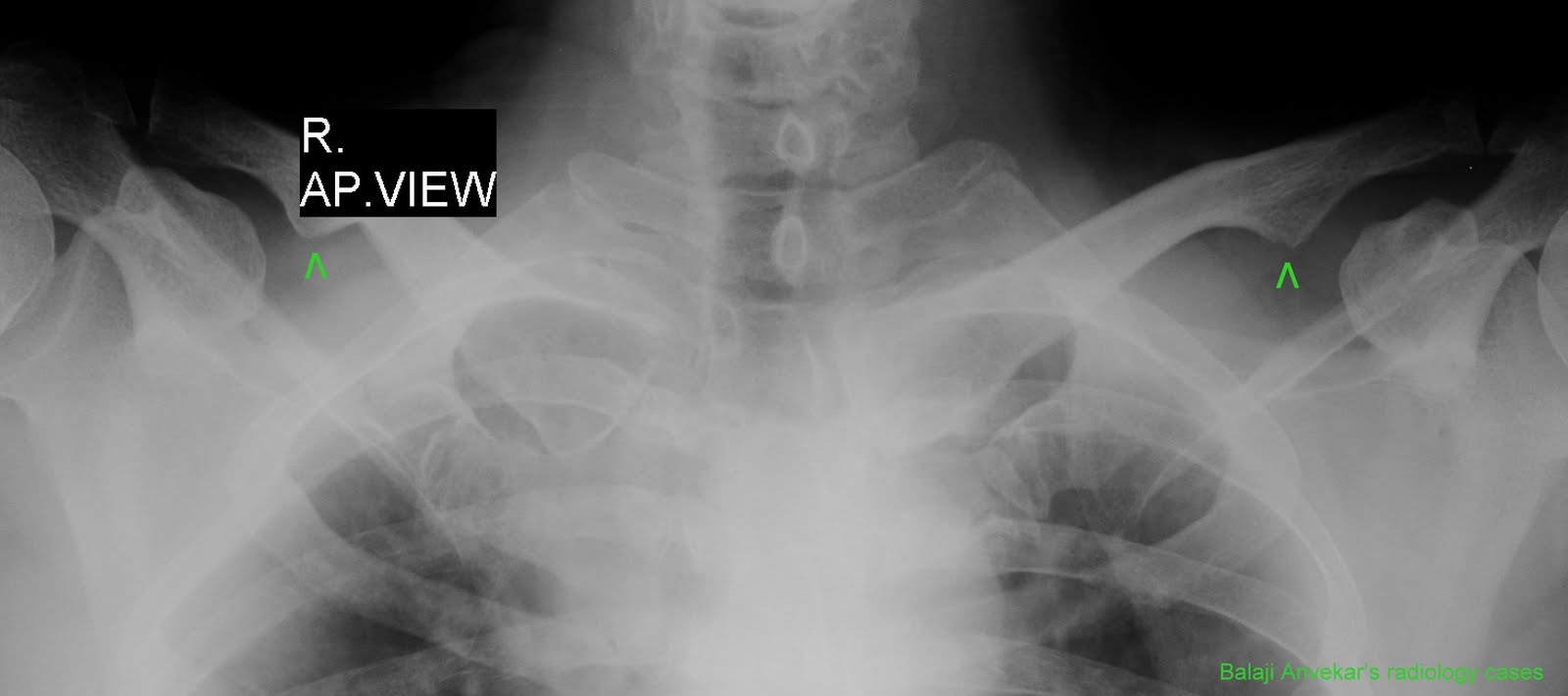 Dr Balaji Anvekar FRCR: Prominent conoid tubercle