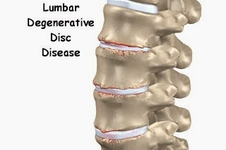 Back Pain Information: Different Kinds of Spondylosis And Their Results ...