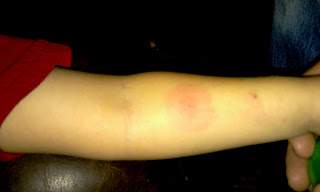 Skeeter Syndrome: Getting Closer...