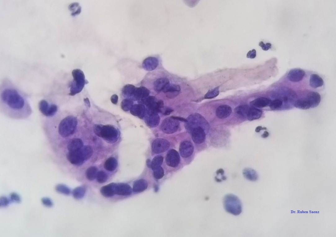 THE PERUVIAN CYTOPATHOLOGY CORNER: CITOLOGÍA CERVICAL: ADENOCARCINOMA ...