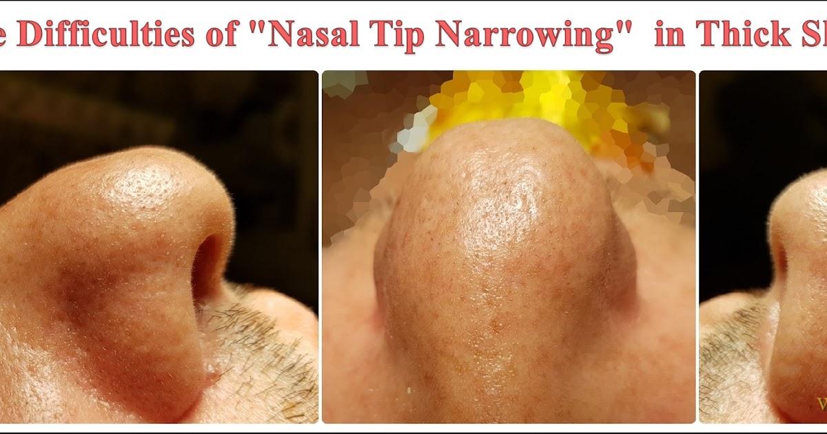 The Difficulties of "Nasal Thinning" in Patients with Thick Nose Tip Skin!