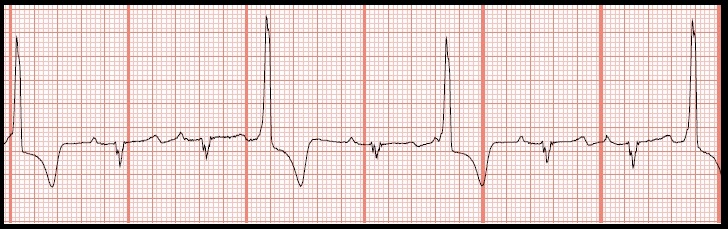 EKG Rhythm Strip Quiz 131
