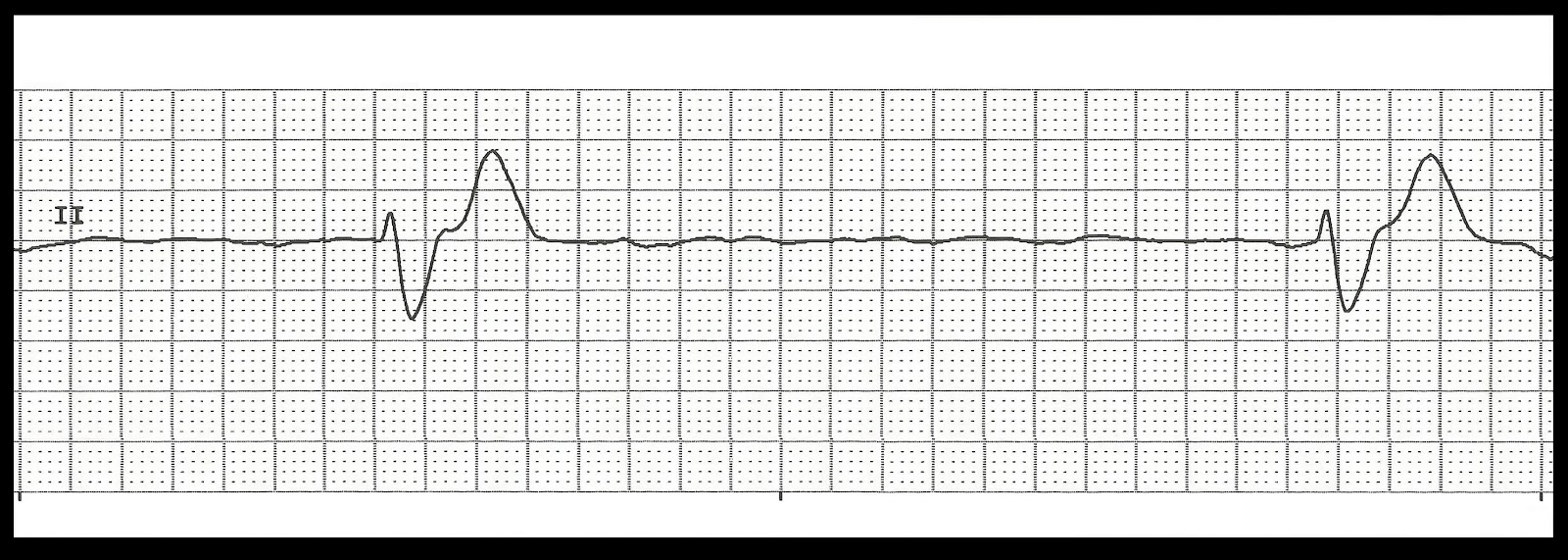 Ventricular rhythm Quiz 294
