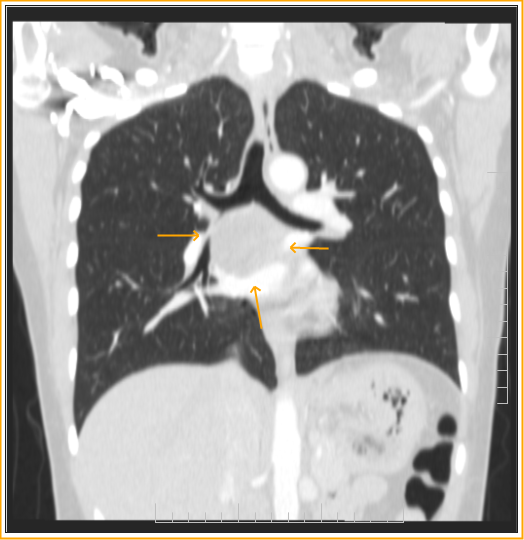 Bronchogenic Cyst-CT - Sumer's Radiology Blog
