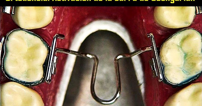 ORTODONCIA: Activación de la Barra de Goshgarian - Odonto-Tv