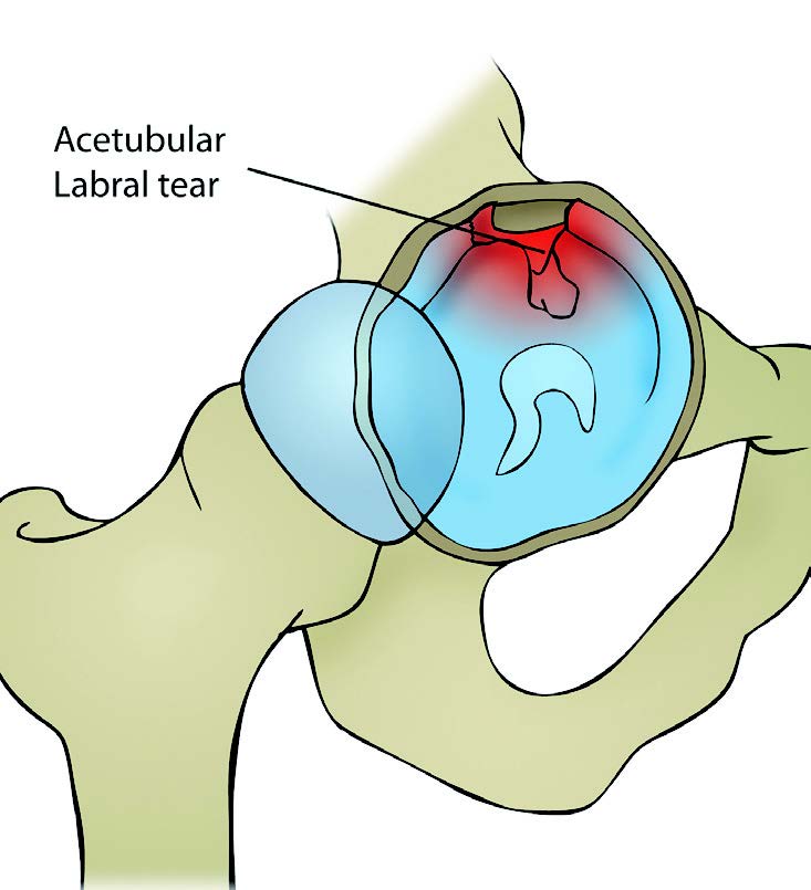 Hip Injury: Acetabular Labral Tears
