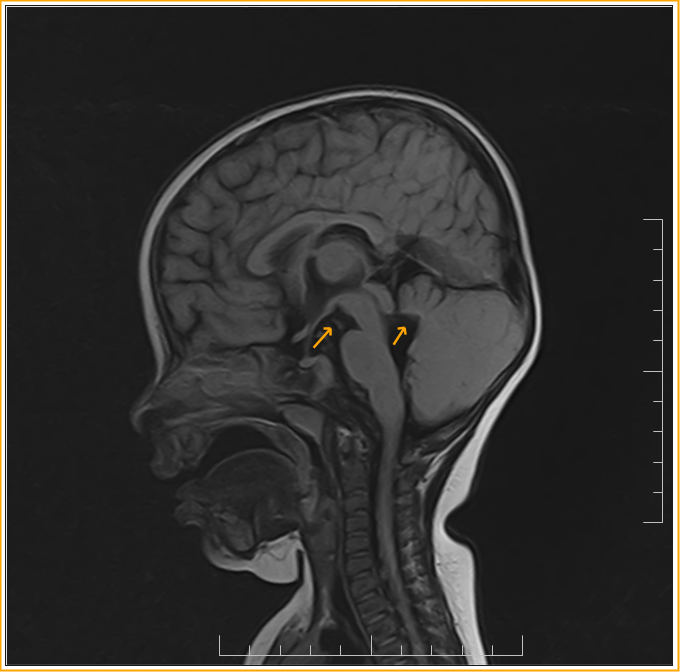 Joubert's Syndrome-MRI - Sumer's Radiology Blog