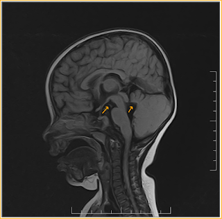 Joubert's Syndrome-MRI - Sumer's Radiology Blog