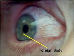 learn nursing: Foreign bodies in the eye, and how to deal with it.