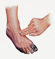 Ulcera del pie diabetico tratamiento | Revertir la Diabetes libro pdf ...