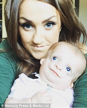 Mom Says She’s Not Ashamed For Her Baby’s Facial Disfigurement | Viral ...