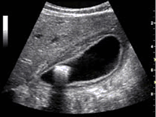 COLELITIASIS ASPECTOS BASICOS