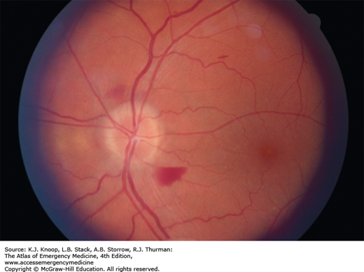 Dr. Saif ALaa ALqaisy: Fundoscopy and Interpret the findings in a ...