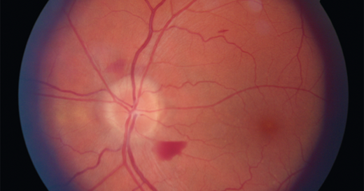 Dr. Saif ALaa ALqaisy: Fundoscopy and Interpret the findings in a ...