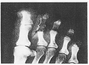 Teknik Radiograf: Teknik Radiografi Pedis pada kasus Fisura pada phalanges