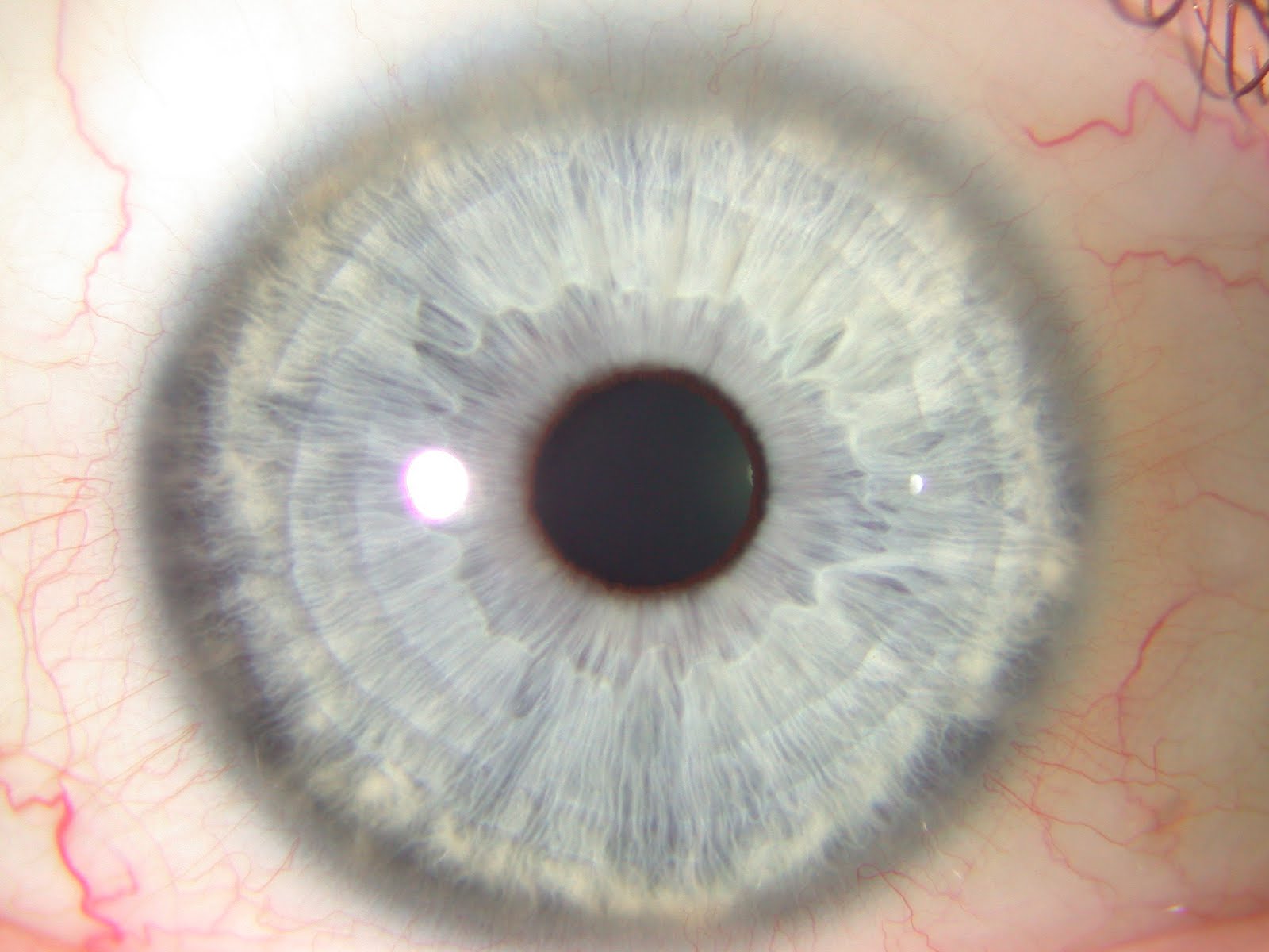 Modern & Multidimensional Iridology: Scurf Rim, Brushfield's Spot ...