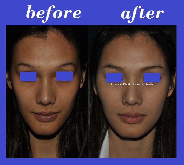 Bangkok Aesthetic Surgery Center: Forehead, Temple And Cheek Bone Fat ...