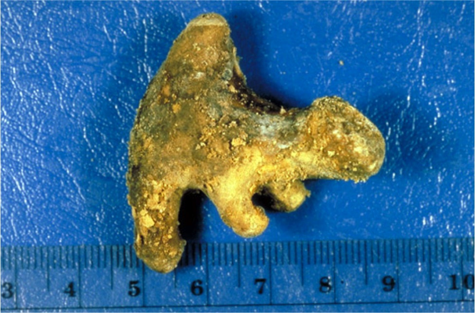 Revista Homeostasis: Urolitiasis